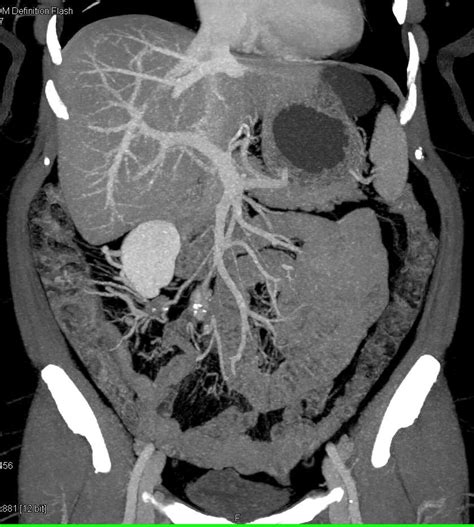 Carcinoid Tumor Root Of Mesentery With Desmoplastic Reaction Small
