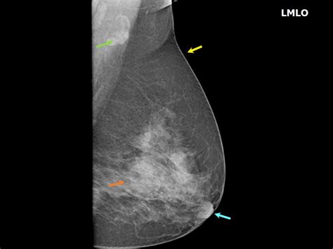 Normal Vs Abnormal Mammogram Results Atlas Of Breast Cancer Early