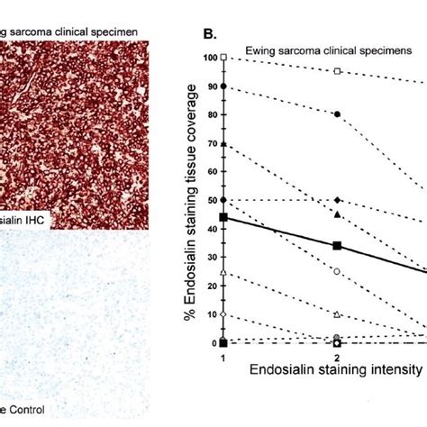 Histologic And Immunohistochemical Features Of Ewing Sarcoma Classic