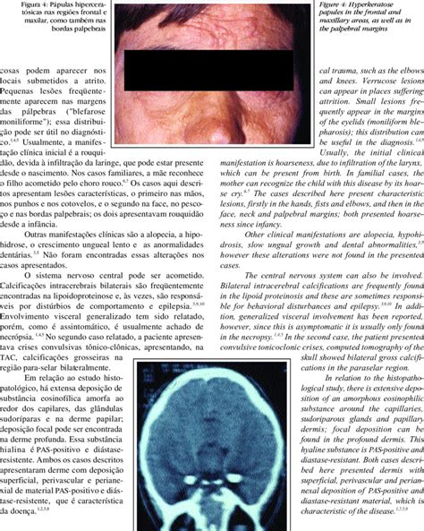Skull Tomography Showing Bilateral Cerebral Calcifications In The Selar