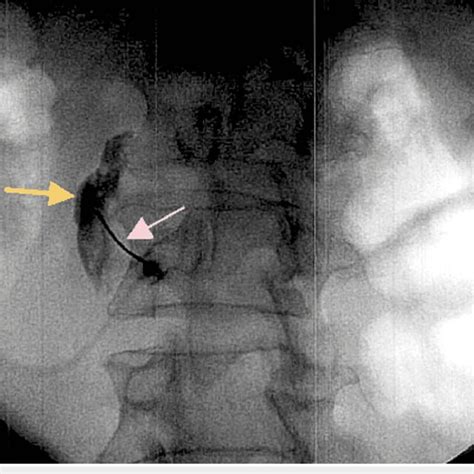 Right Sided Stellate Ganglion Block Under Fluoroscopic Guidance Using Download Scientific