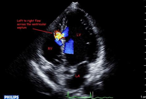 The Queens School Medical Society Ventricular Septal Defect ‘hole In