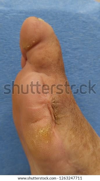 7 Imágenes De First Ray Amputation Imágenes Fotos Y Vectores De Stock Shutterstock