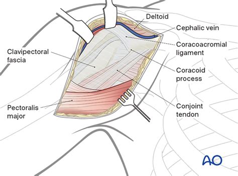 Deltopectoral Interval Approach To The Proximal Humerus
