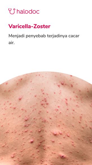 Ketahui Jenis Virus Yang Bisa Sebabkan Herpes