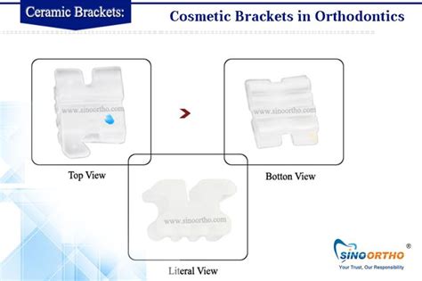 Cosmetic Brackets In Orthodontics 1 The Big Slot Is More Smooth2