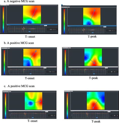 A 90 Second Magnetocardiogram Using A Novel Analysis System To Assess
