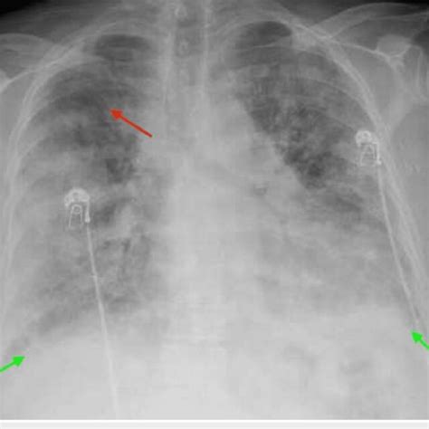 Chest X Ray Showing Ground Glass Opacity Diffuse Patchy Airspace Download Scientific Diagram
