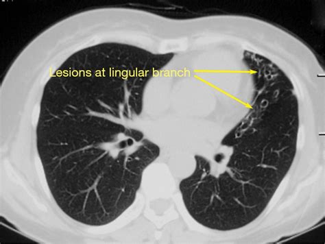 Robotic Assisted Segmentectomy Of Lingual Segment Of The Left Upper Pulmonary Lobe Abstract