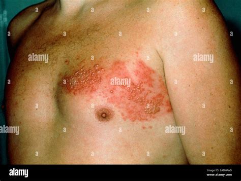 Shingles Rash On A Mans Chest Shingles Herpes Zoster Is Caused By