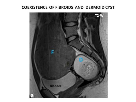 Coexistence Of Fibroids And Dermoid Cyst In A 33 Year Old Woman Download Scientific Diagram