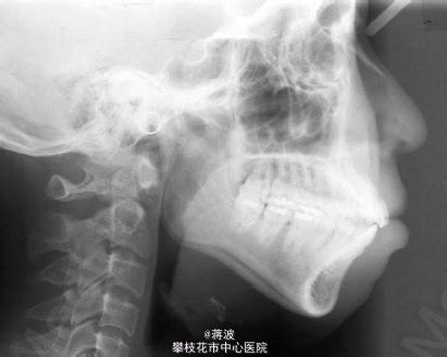双颌前突非手术矫治