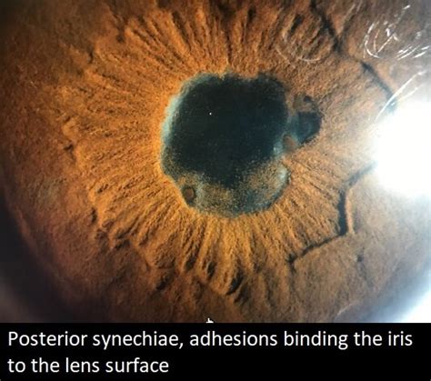 Anterior Synechiae