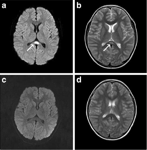 Mri Findings Of Case 1 Diffusion Weighted Image A And T2 Weighted Download Scientific