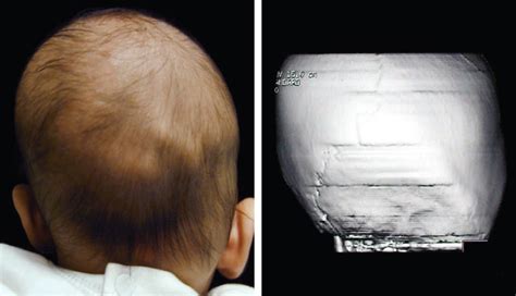 Craniosynostosis Plastic Surgery Key