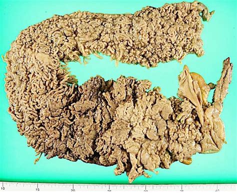 E Macroscopic Findings Of The Formalin Fixed Resected Colon Download Scientific Diagram
