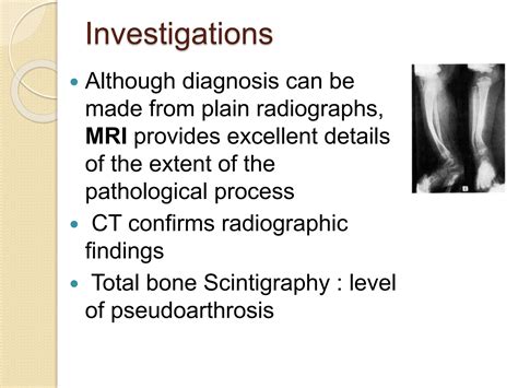 Pseudoarthrosis Of Tibia Pptx