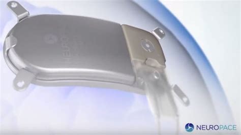 Neuropace Brain Implant Reduces Epilepsy Seizures In Long Term Trial