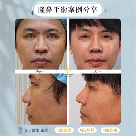 鼻子醫生｜張簡仕煌 隆鼻專家👃🏻 L先生因為鼻頭下旋，鼻樑扁平，鼻翼寬大問題前來本院手術。 我利用鼻中膈軟骨及耳軟骨撐高並縮小鼻頭，鼻骨截