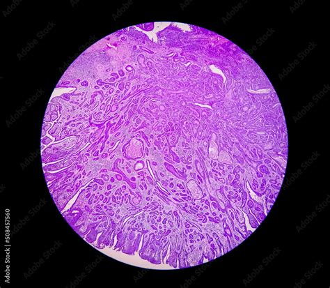 Histological Slide Under Microscopy Showing Pedunculated Squamous