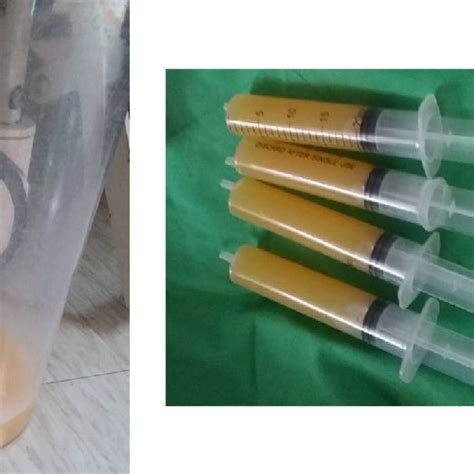 Chylous Pleural Effusion Yellow And Milky Pleural Effusion Of The