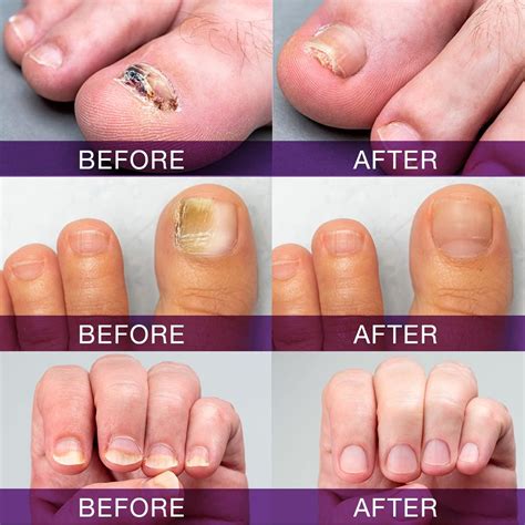 Pureskin Fungal Nail Renewal Maximum Strength Treatment For Nail