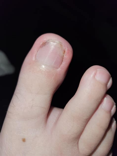 Hypergranulation Tissue Post Surgery R Ingrown Toenails