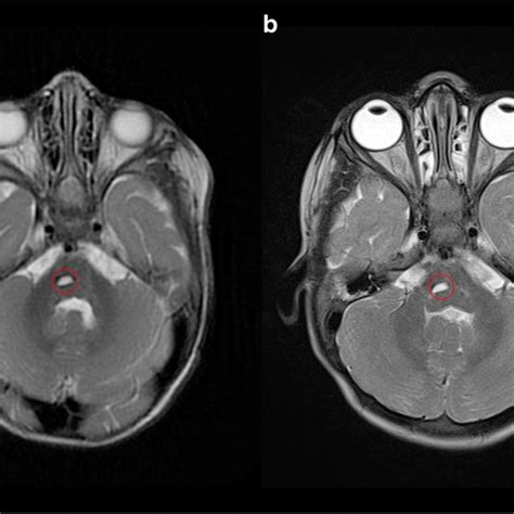 Axial 3d Tof Time Of Flight Spgr Spoiled Gradient Recalled Echo Mri Download Scientific