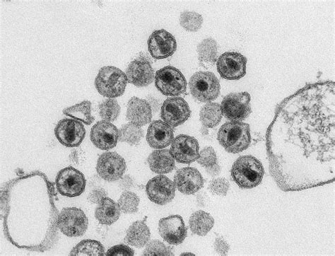 Priming Vaccine Tested By Global Project Lays Path To Hiv Vaccine