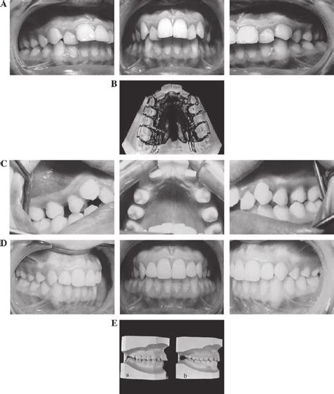 Intraoral Photographs Of Patient 1 Before Distalization A The