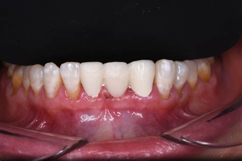 下前牙烤瓷换全瓷改形 拔牙蜀黍的博客 Kq88口腔博客