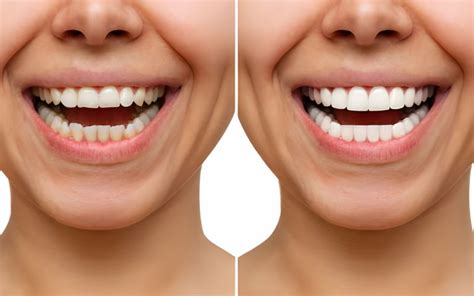 Discover The Beauty Of Partial Veneers A Comprehensive Guide