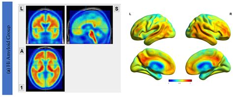 Level Of Amyloid β Aβ Binding Leading To Differential Effects On
