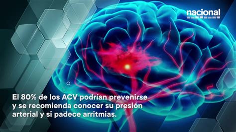 Hoy Se Conmemora El Día Mundial Del Accidente Cerebrovascular