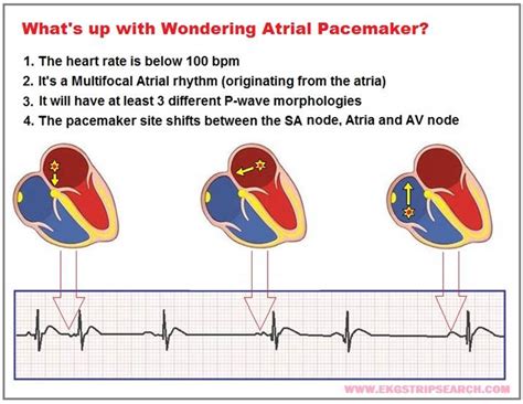 Wandering Atrial Rhythm