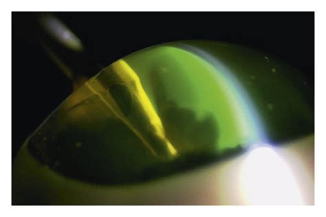 Viscous Dispersive Type Of Ophthalmic Viscosurgical Devices Ovds A Download Scientific