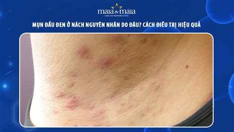 Mụn đầu đen ở Nách Nguyên Nhân Do đâu Điều Trị Như Thế Nào