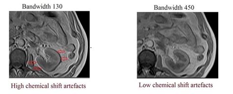 Mri Bandwidth And Image Quality Setting Up Mri Protocols Use Rf