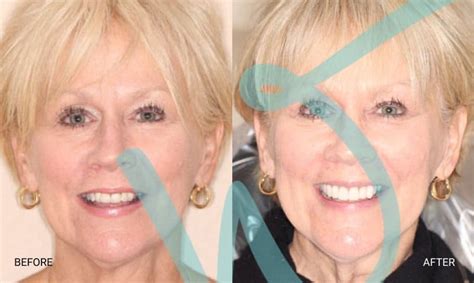 A Partial Smile Makeover With Crowns And Veneers