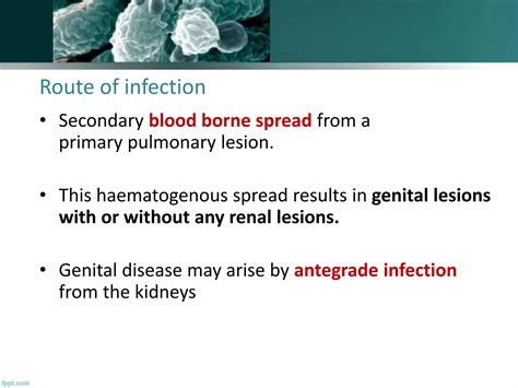 Tb Epididymitis By Emad Mqasem Ppt