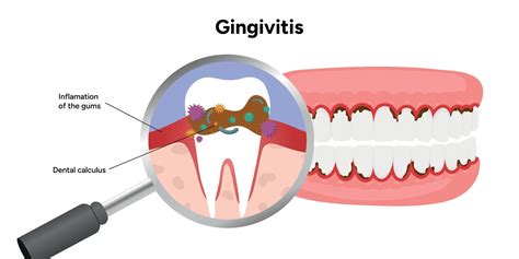Dental Teeth Gingivitis Educational Medical Infographic Gum