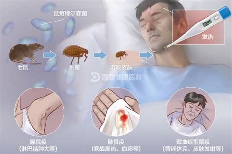 鼠疫（鼠疫耶尔森菌借鼠蚤传播为主的烈性传染病）百度百科