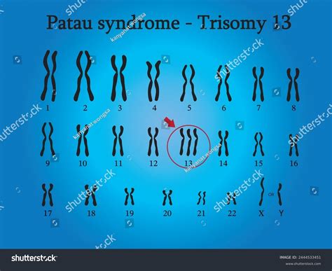 Patau Syndrome Trisomy 13