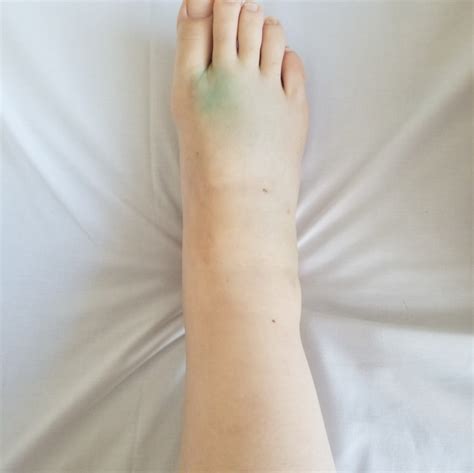 安静にしなくていいんですか！？ もじゃの乳房再建・修正の旅 〜旅紀行〜