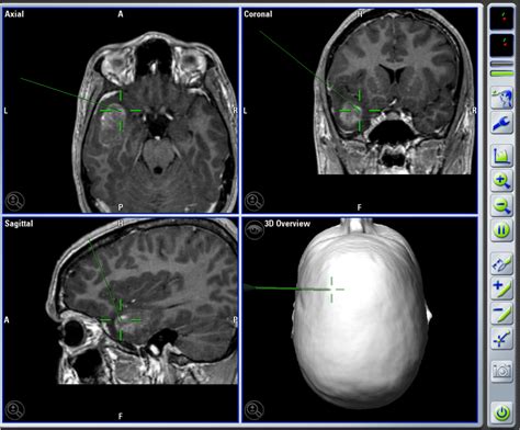 Tratamiento De Cavernoma Temporal