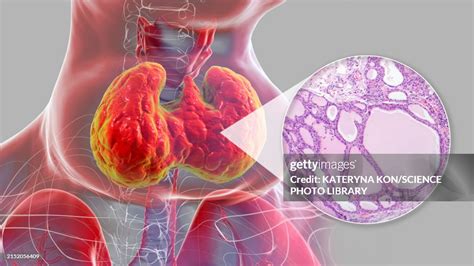 Endemic Goitre Of Thyroid Gland 3d Illustration High Res Vector Graphic