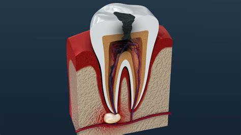 Gum Abscess Stock Video Footage 4k And Hd Video Clips Shutterstock