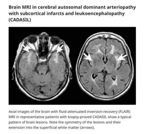 Genetics Ch 11 Monogenic Disorders Flashcards Quizlet
