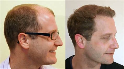 Haartransplantation Schweiz NW 5 Glatze 4712 Grafts Vorher Nachher