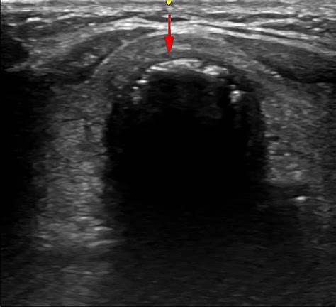 The Inter Annular Space Between The Second And Third Tracheal Ring The Download Scientific